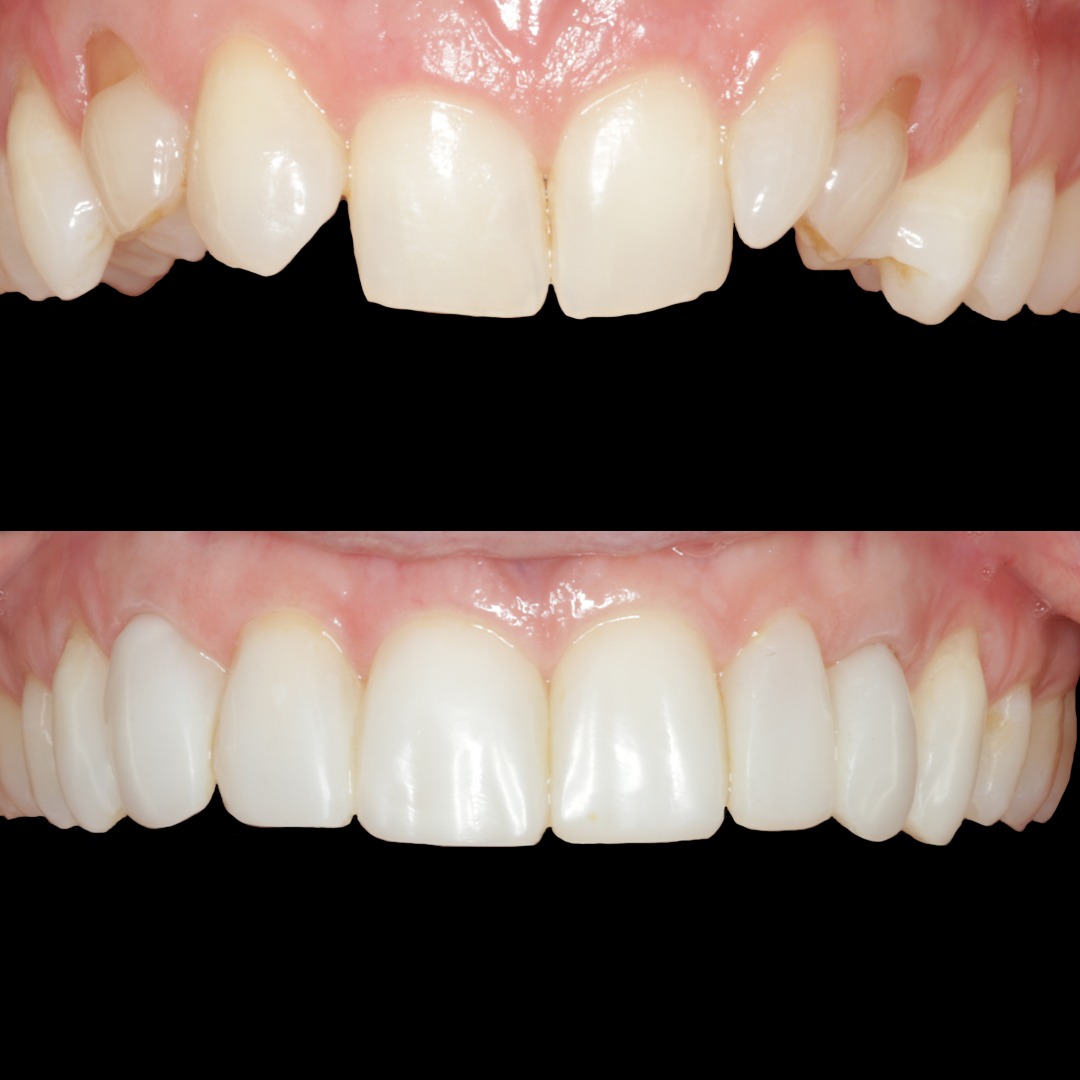 Transform Your Smile with Braces | Seapoint Clinic | Dental Clinic Transform Your Smile with Braces | Seapoint Clinic | Dental Clinic