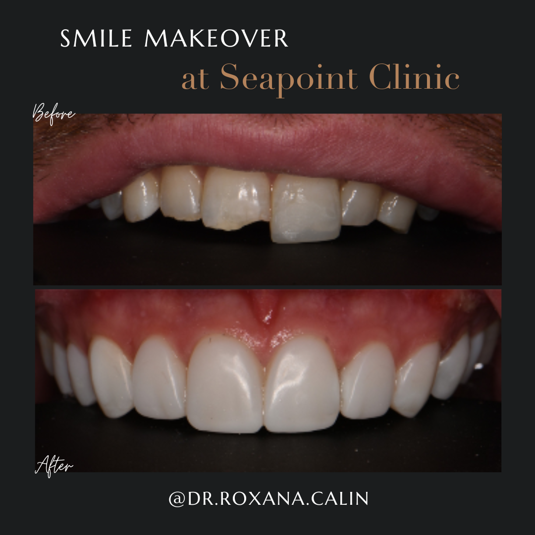 Transform Your Smile with Composite Veneers: The Ultimate Guide to ... Transform Your Smile with Composite Veneers: The Ultimate Guide to ...
